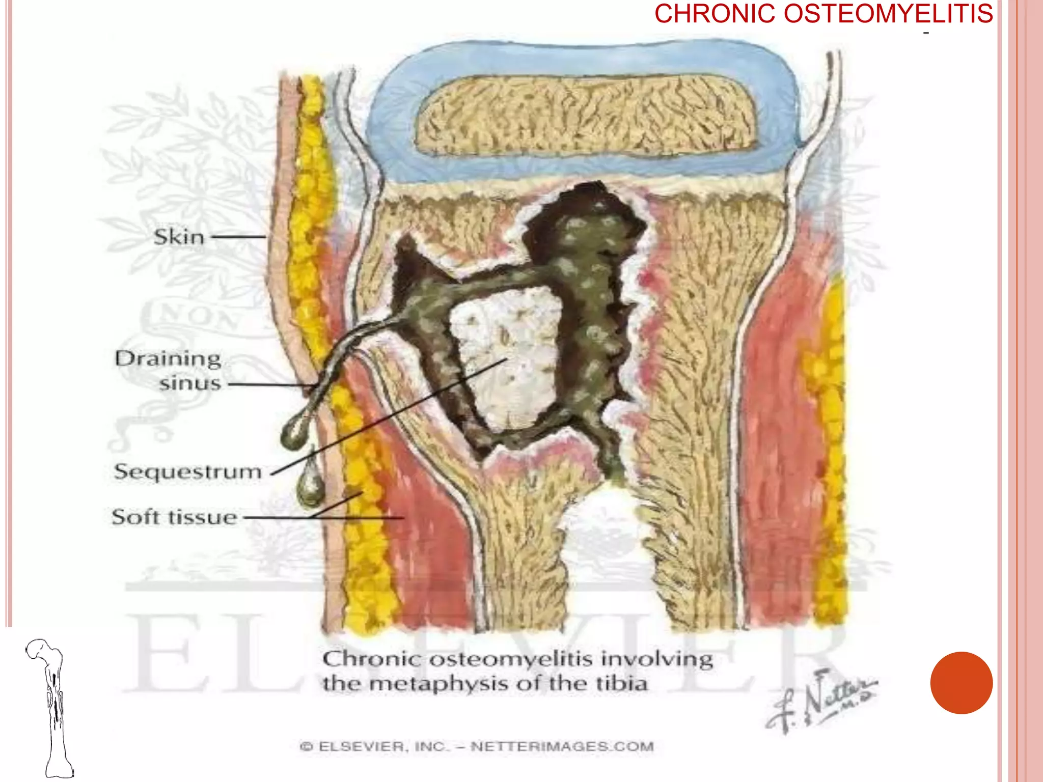 Osteomyelitis | PPTX