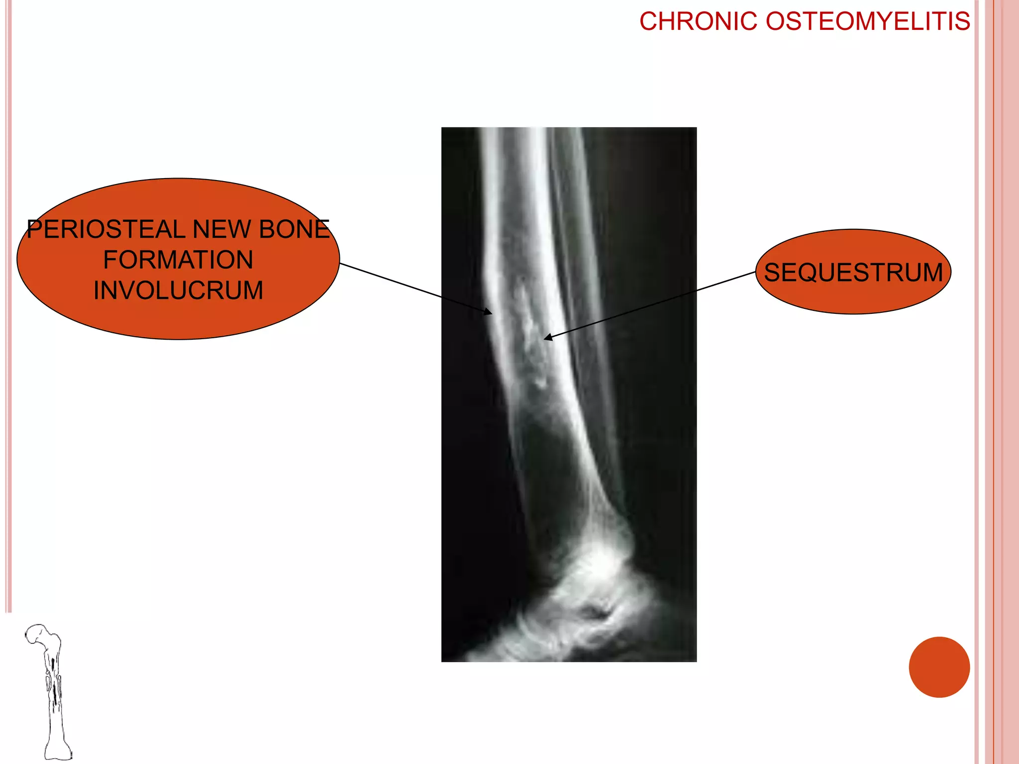 Osteomyelitis | PPTX