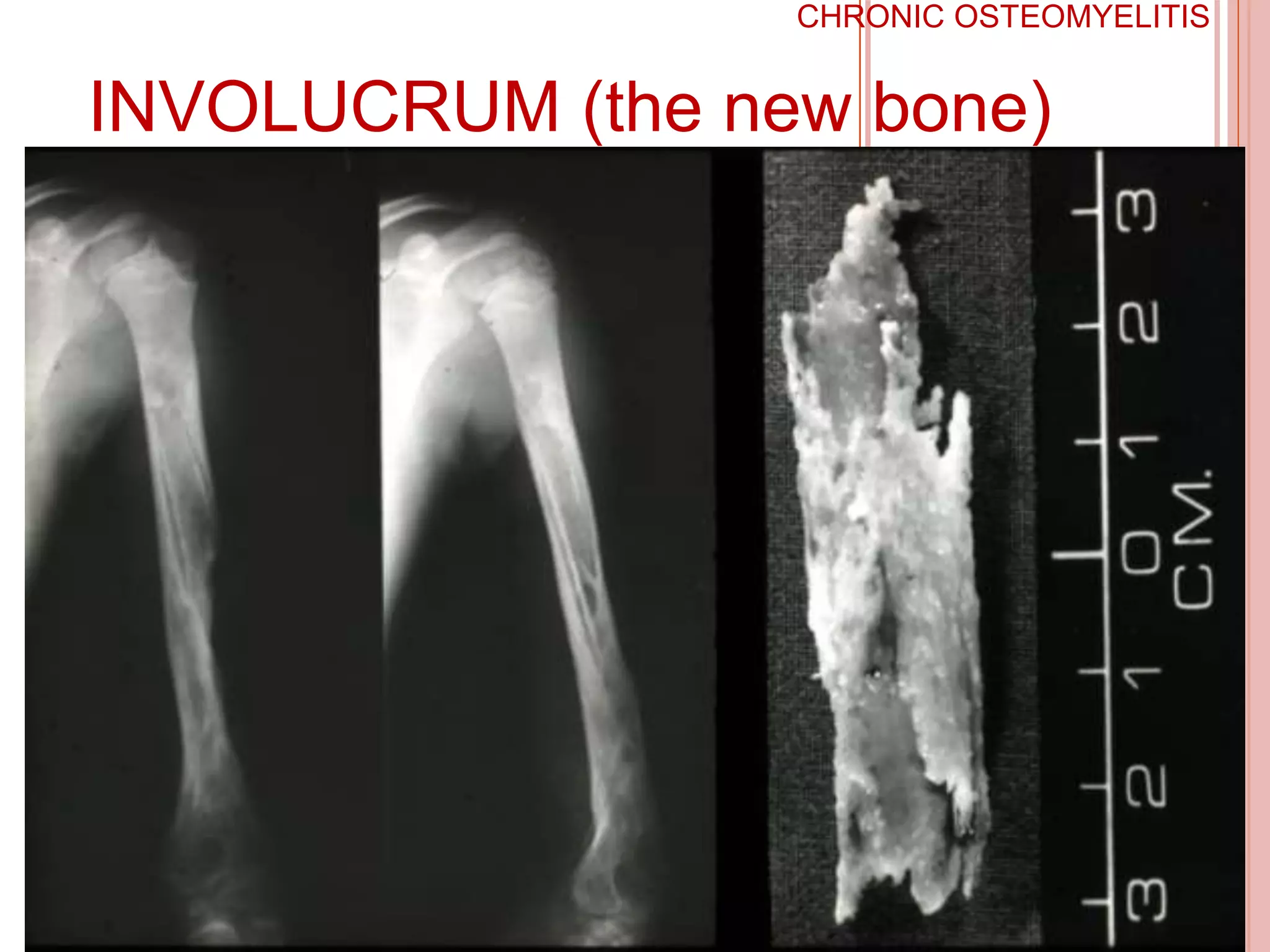 Osteomyelitis | PPTX