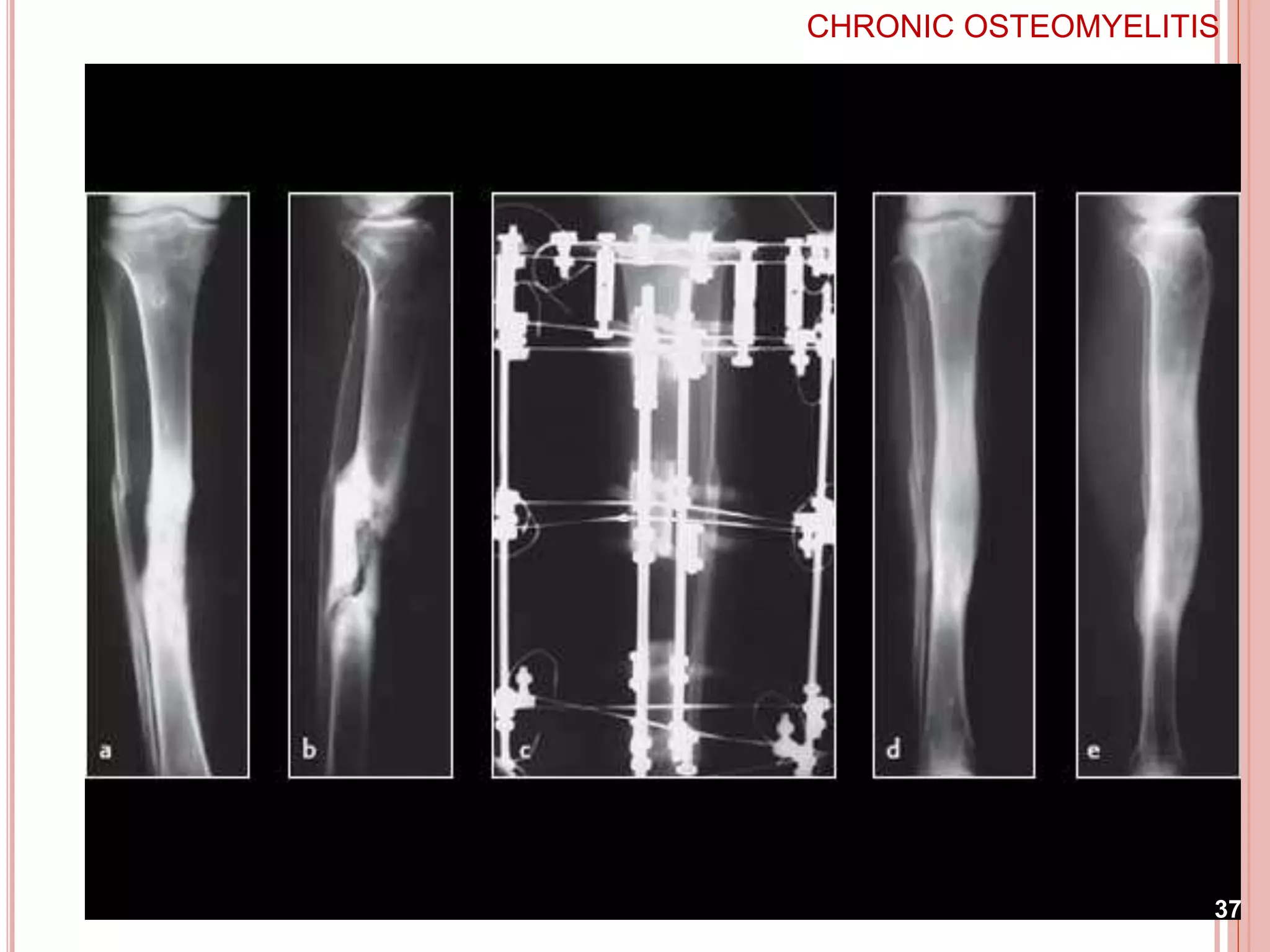 Osteomyelitis | PPTX