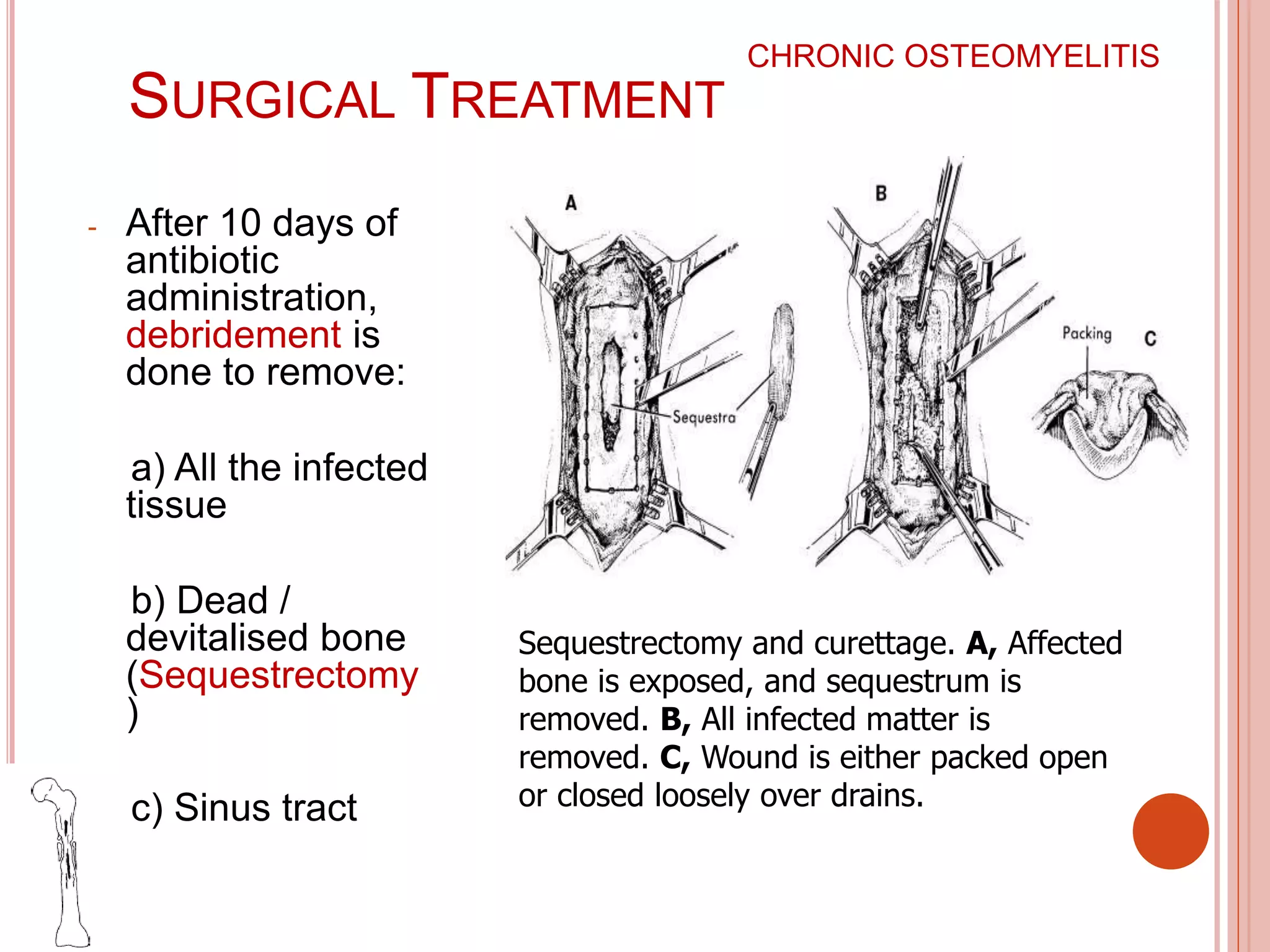 Osteomyelitis | PPTX