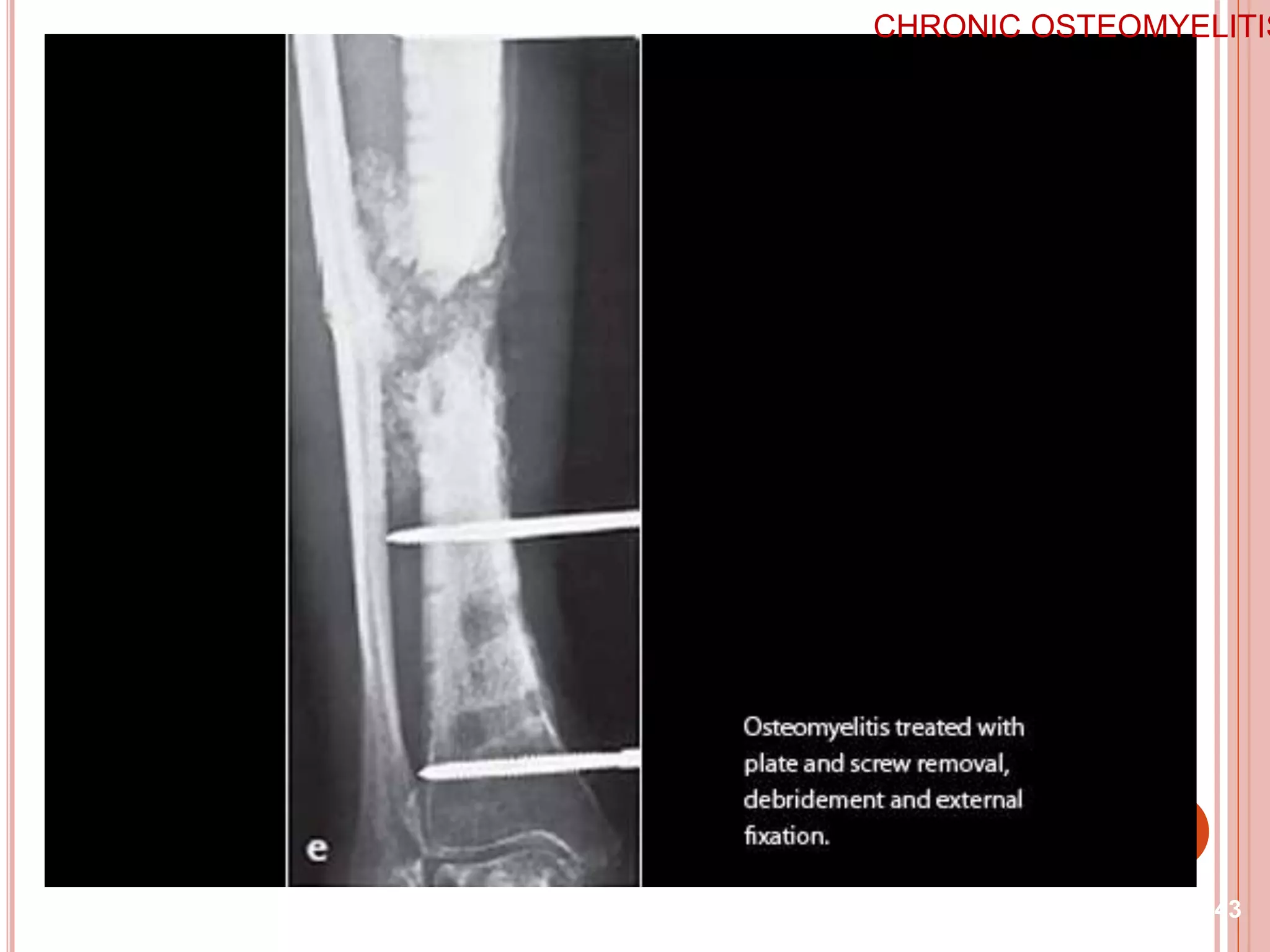 Osteomyelitis | PPTX