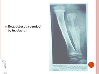 Osteomyelitis | PPTX