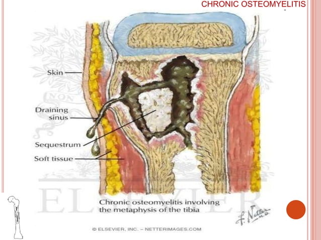 Osteomyelitis | PPTX