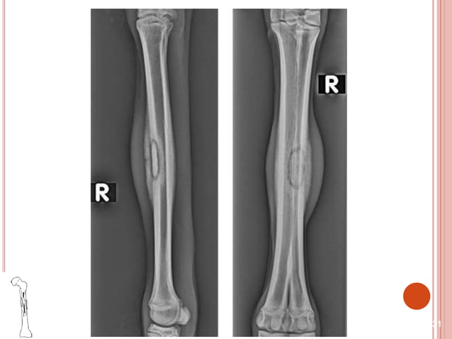 Osteomyelitis | PPTX