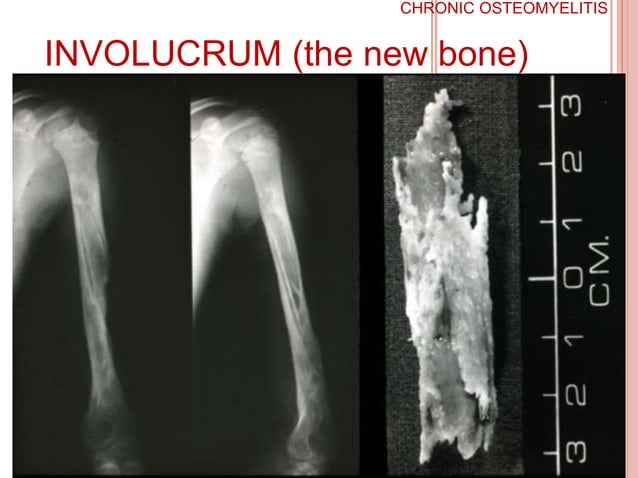 Osteomyelitis | PPTX