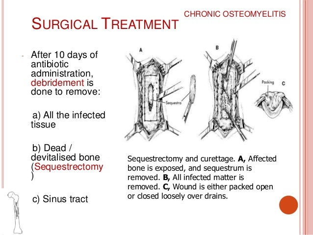 Osteomyelitis