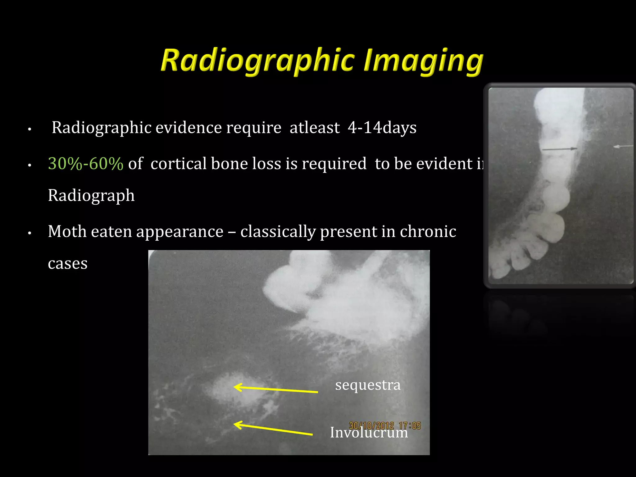 Osteomyelitis in maxillofacial region | PDF