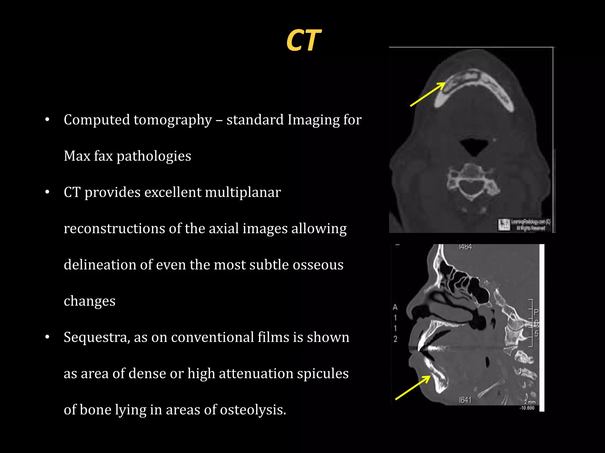 Osteomyelitis in maxillofacial region | PDF
