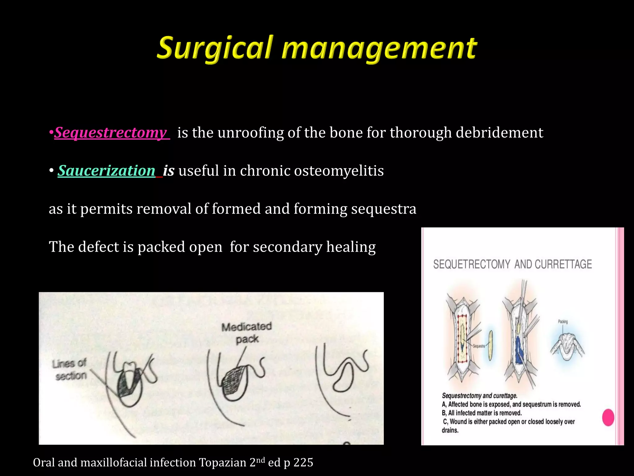 Osteomyelitis in maxillofacial region | PDF