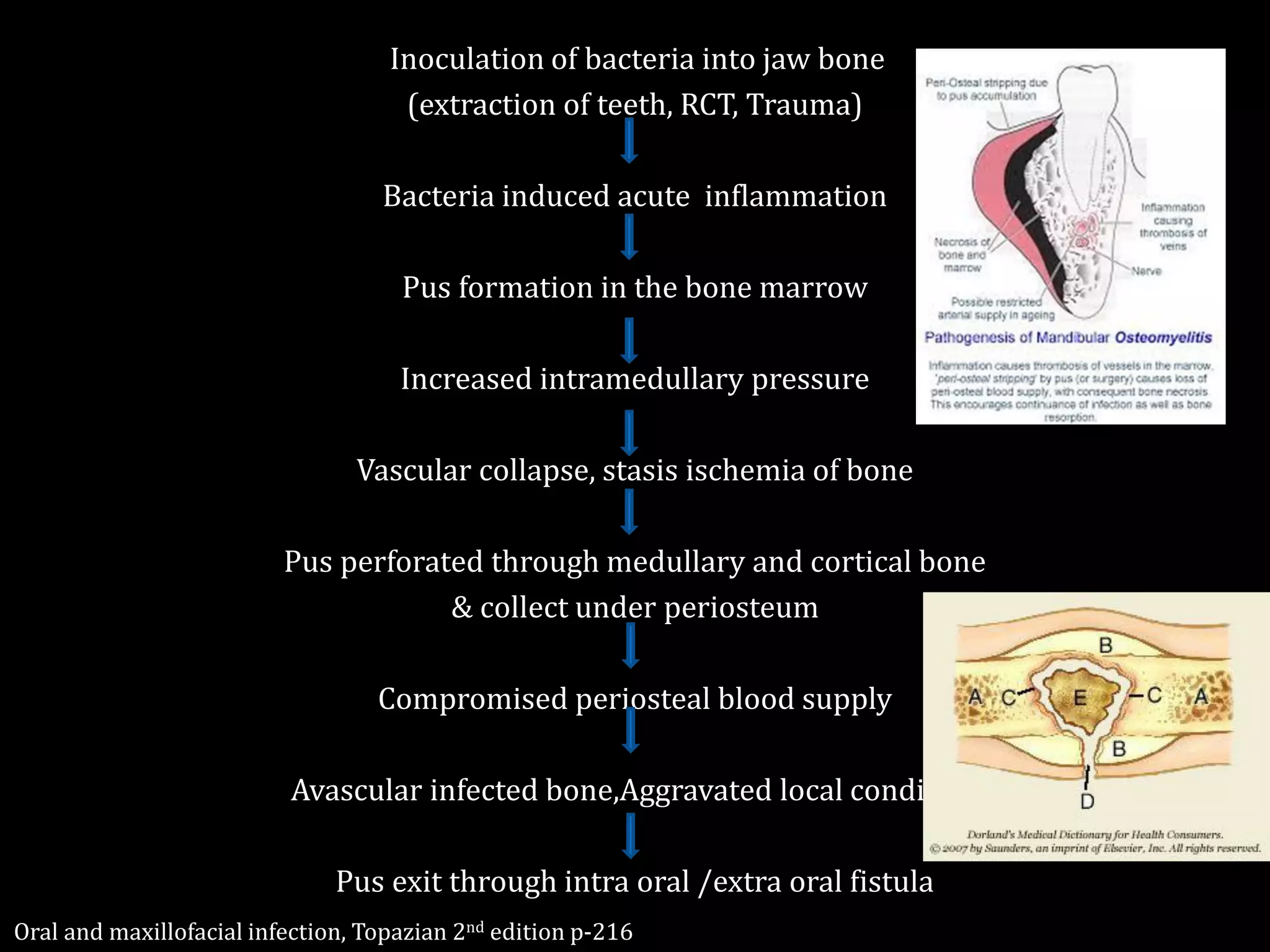 Osteomyelitis in maxillofacial region | PDF