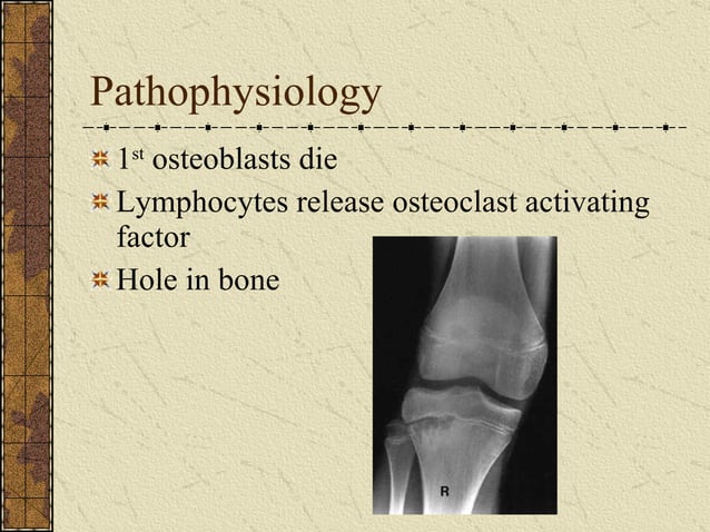 Osteomyelitis+in+Children | PPT | Bone and Joint Conditions | Diseases ...