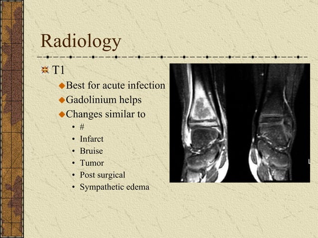 Osteomyelitis+in+Children | PPT | Bone and Joint Conditions | Diseases ...