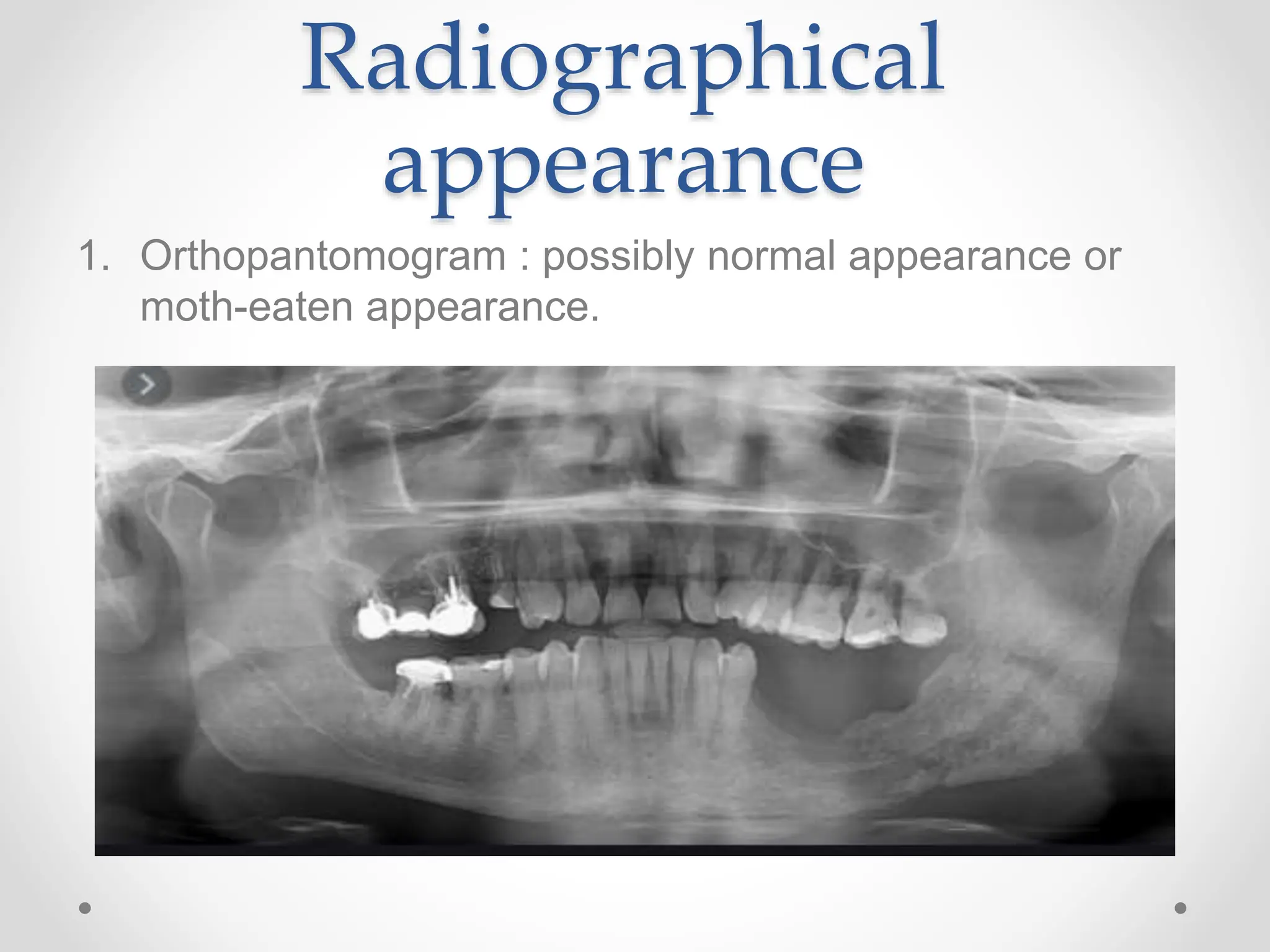 Osteomyelitis_Inflammatory_bone_Diseases_ppt ...