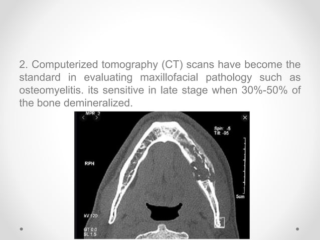 Osteomyelitis_Inflammatory_bone_Diseases_ppt ...