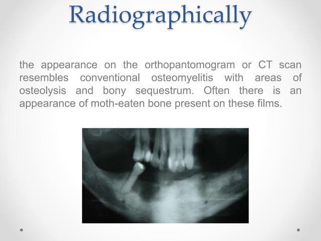 Osteomyelitis_Inflammatory_bone_Diseases_ppt ...