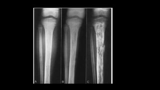 Osteomyelitis investigation profile | PPTX