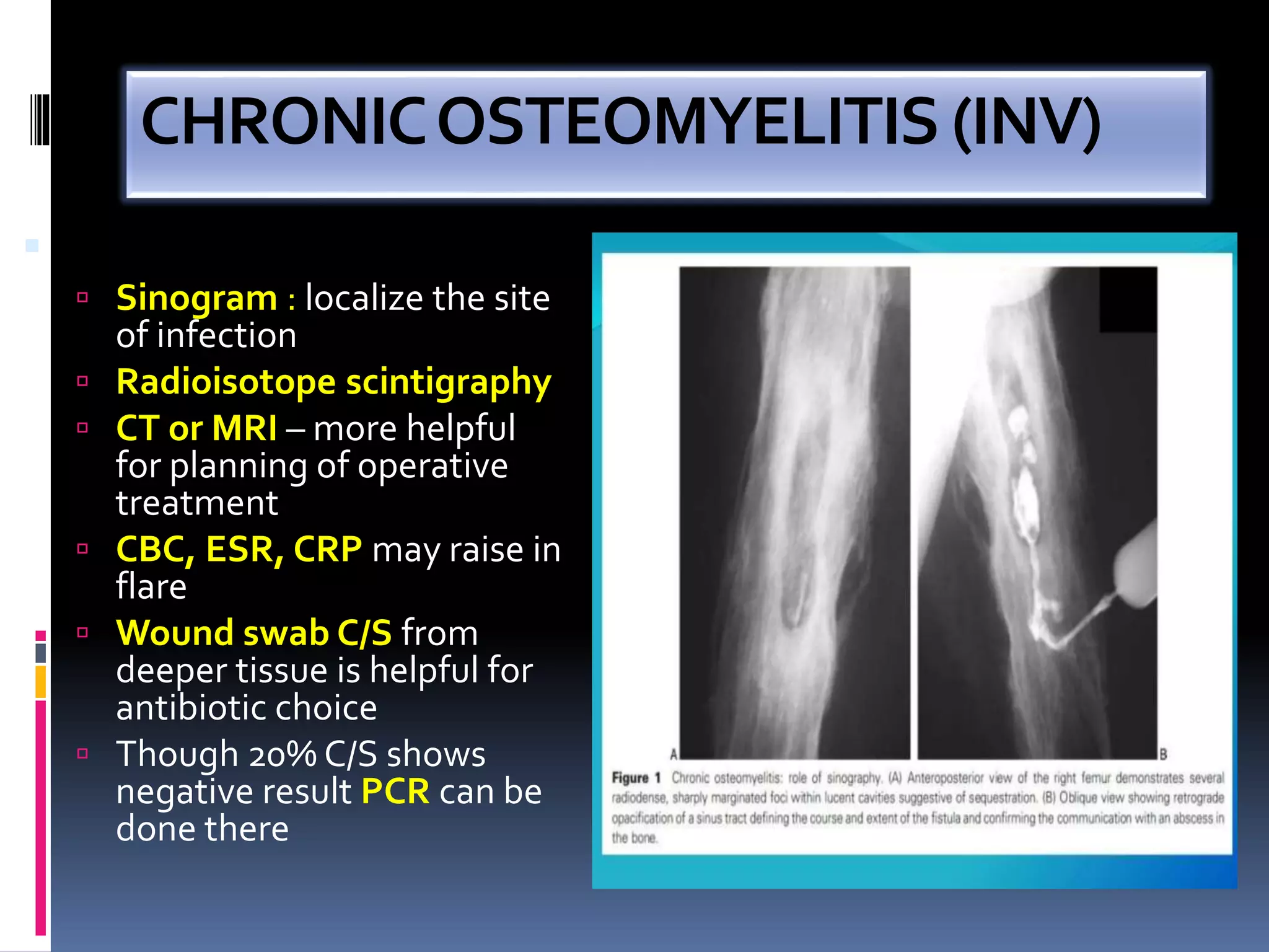 Osteomyelitis & its management | PPTX