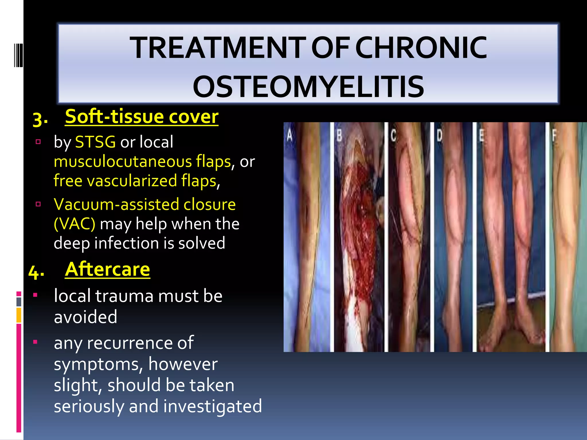 Osteomyelitis & its management | PPTX
