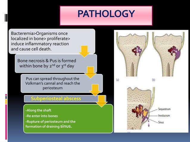 Osteomyelitis & its management | PPTX