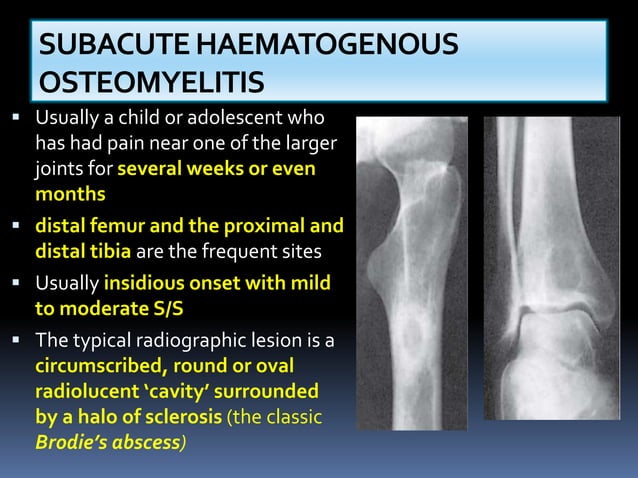 Osteomyelitis & its management | PPTX