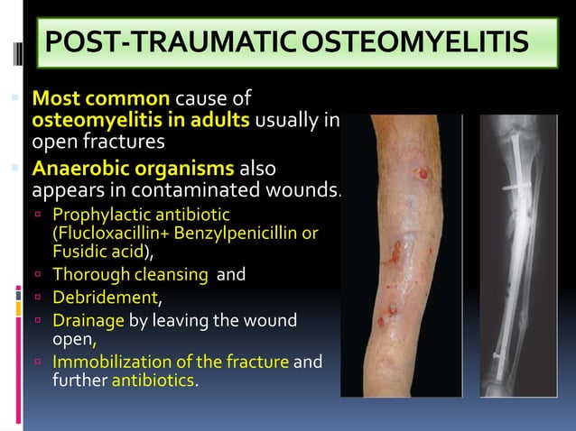 Osteomyelitis & its management | PPTX