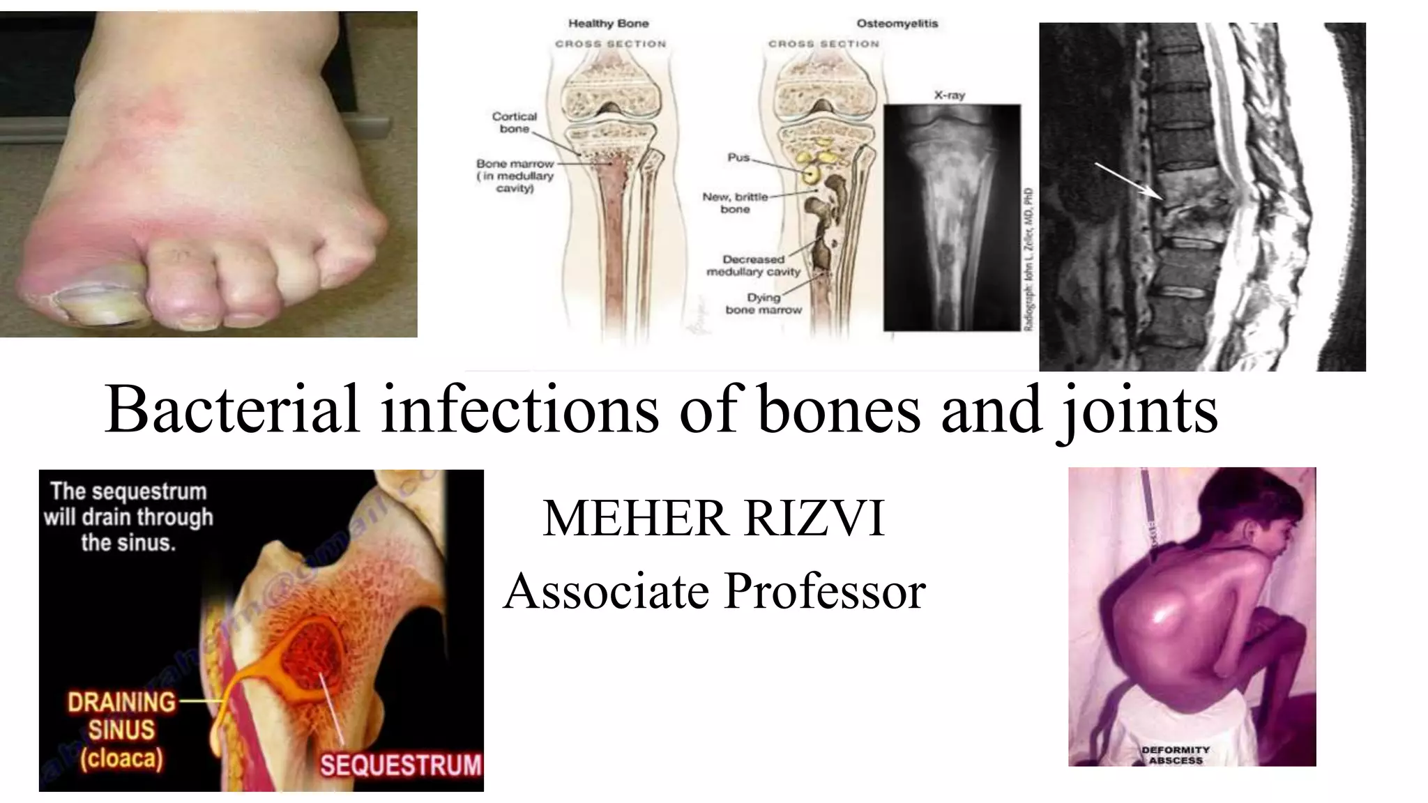 Osteomyelitis march 2018 | PPTX