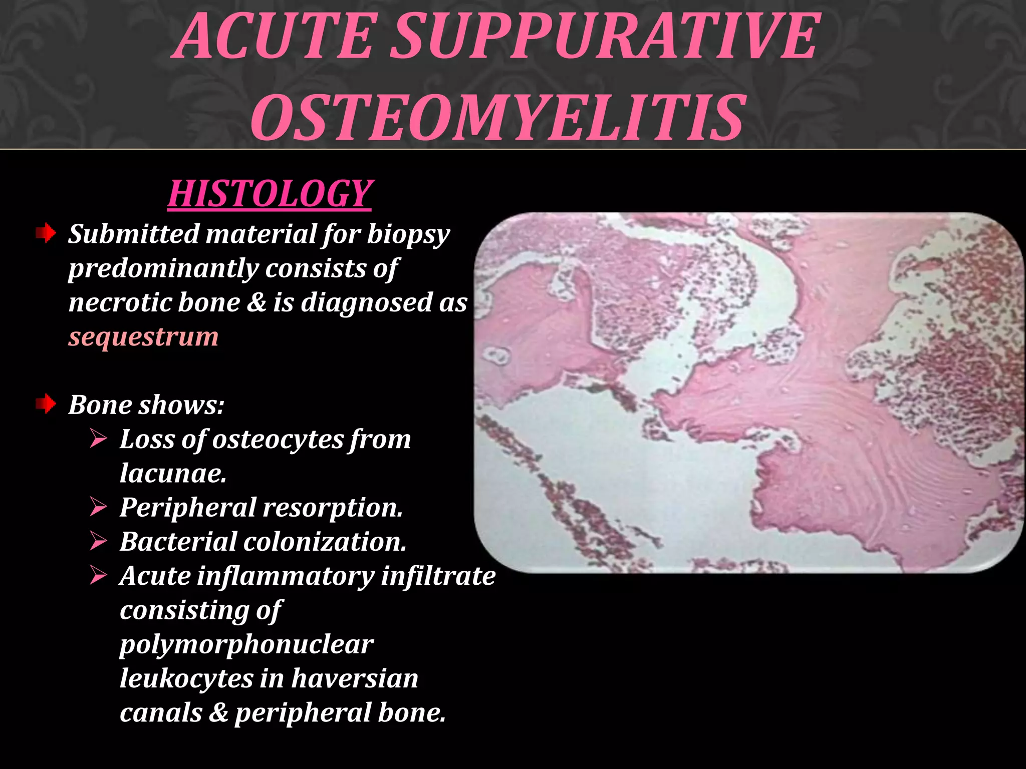 Osteomyelitis of jaw | PPTX