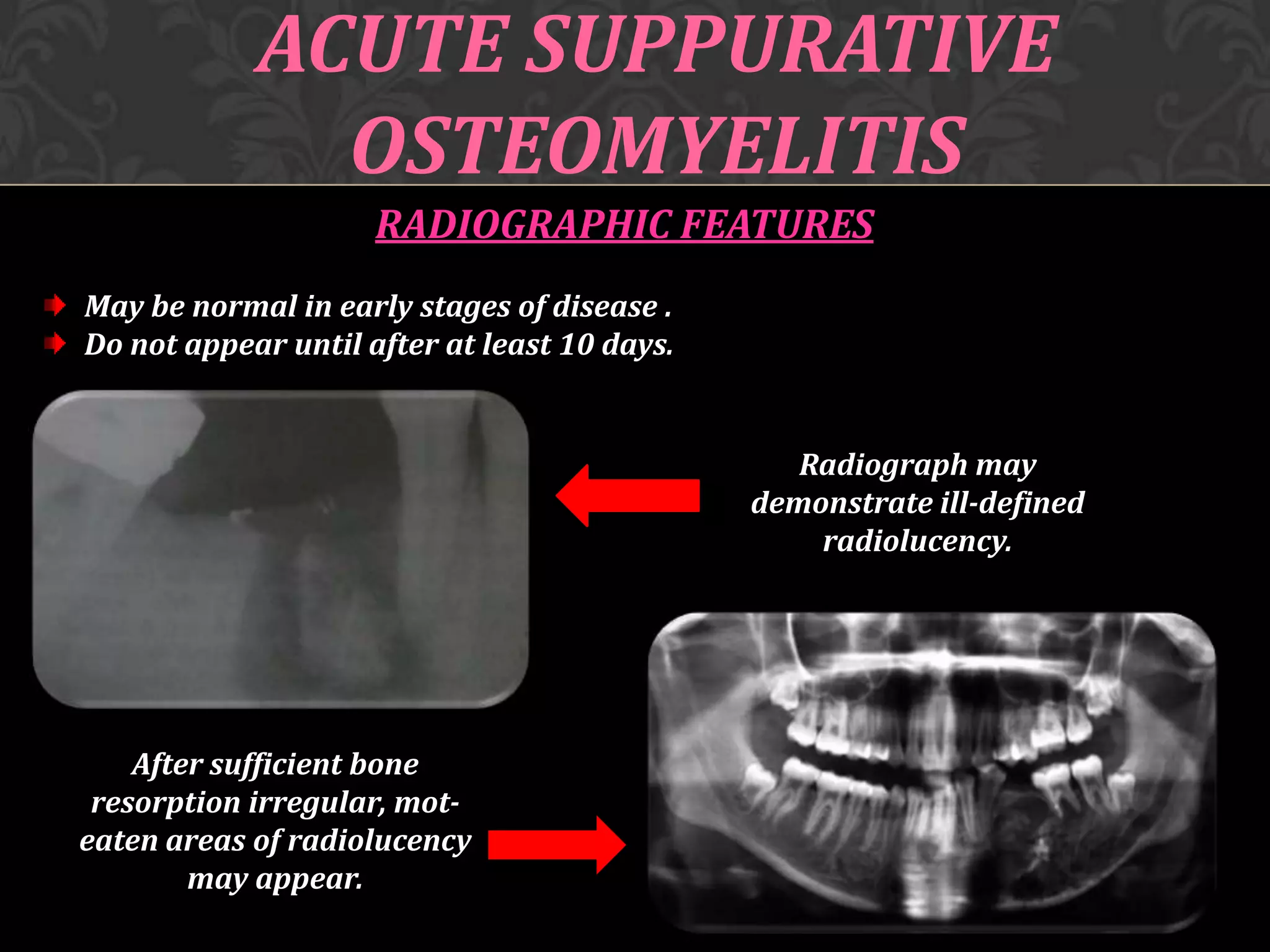 Osteomyelitis of jaw | PPTX