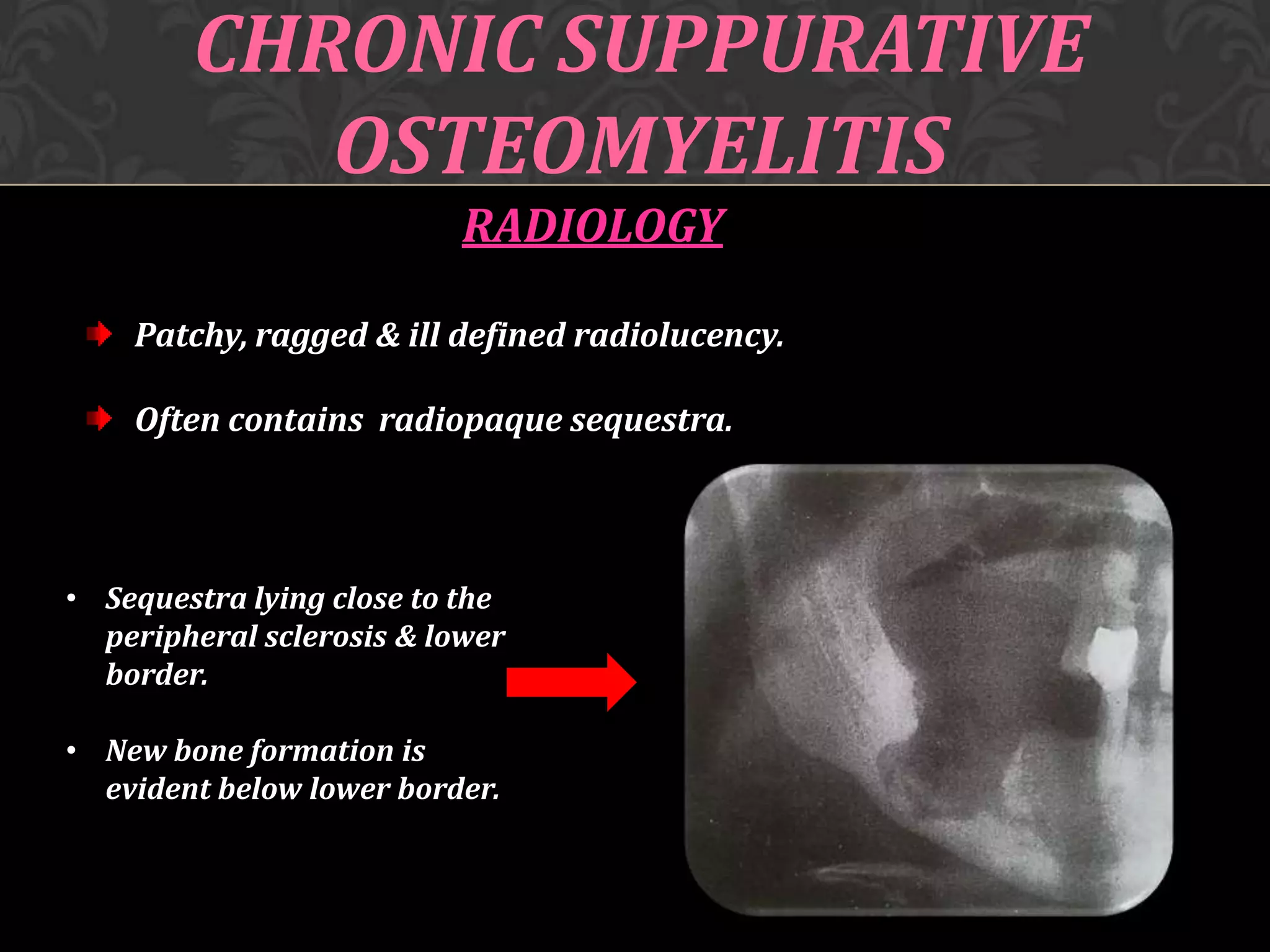 Osteomyelitis of jaw | PPTX
