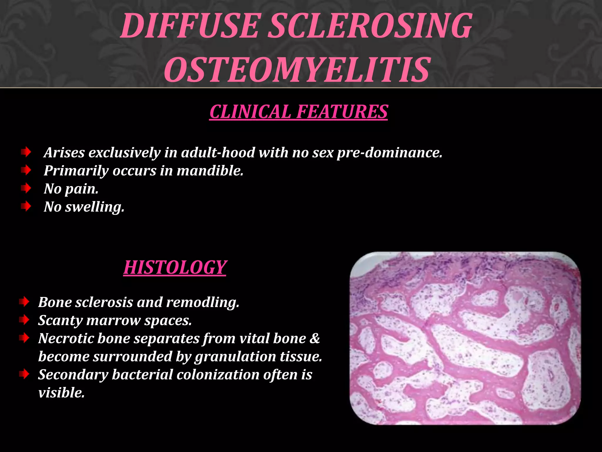 Osteomyelitis of jaw | PPTX