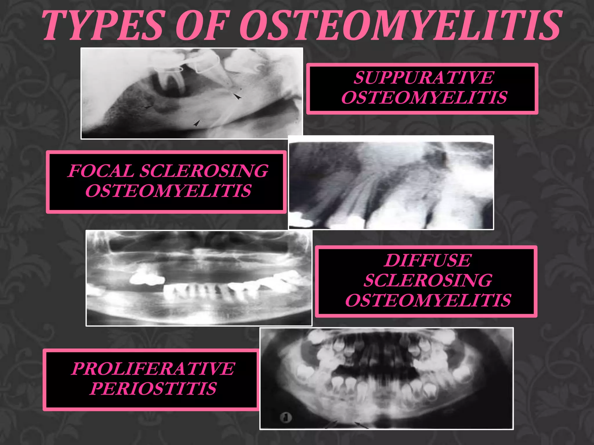Osteomyelitis of jaw | PPTX