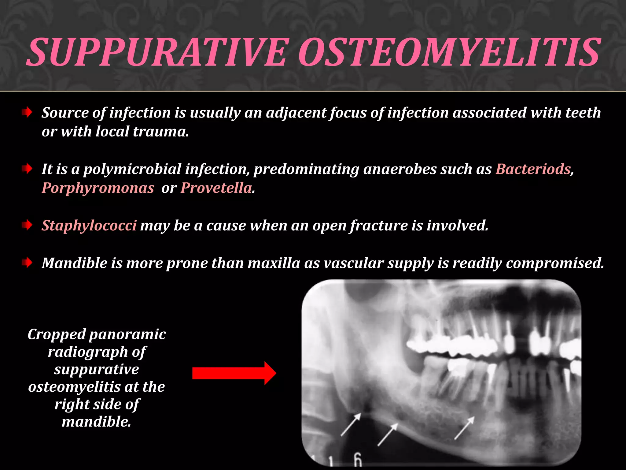 Osteomyelitis of jaw | PPTX