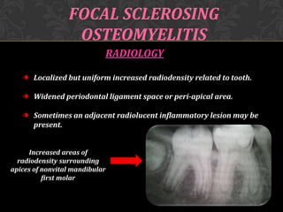 Focal Sclerosing Osteomyelitis