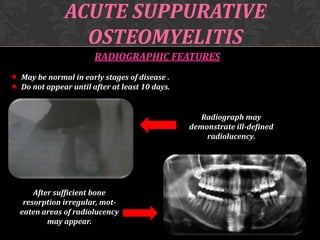 Osteomyelitis Jaw Radiographic Appearance