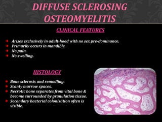 Diffuse Sclerosing Osteomyelitis