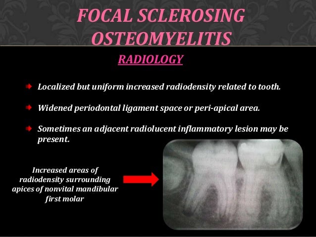 Osteomyelitis of jaw