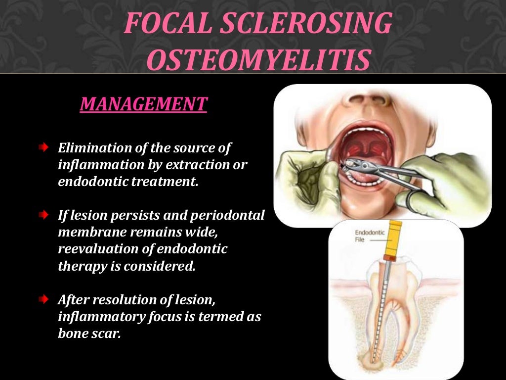 Osteomyelitis Of Jaw