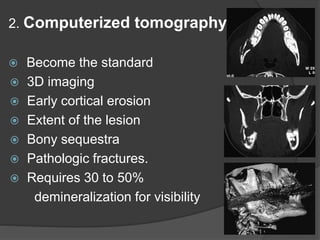 Osteomyelitis of jaws | PPTX