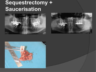 Osteomyelitis of jaws | PPTX