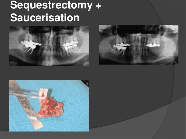 Osteomyelitis of jaws