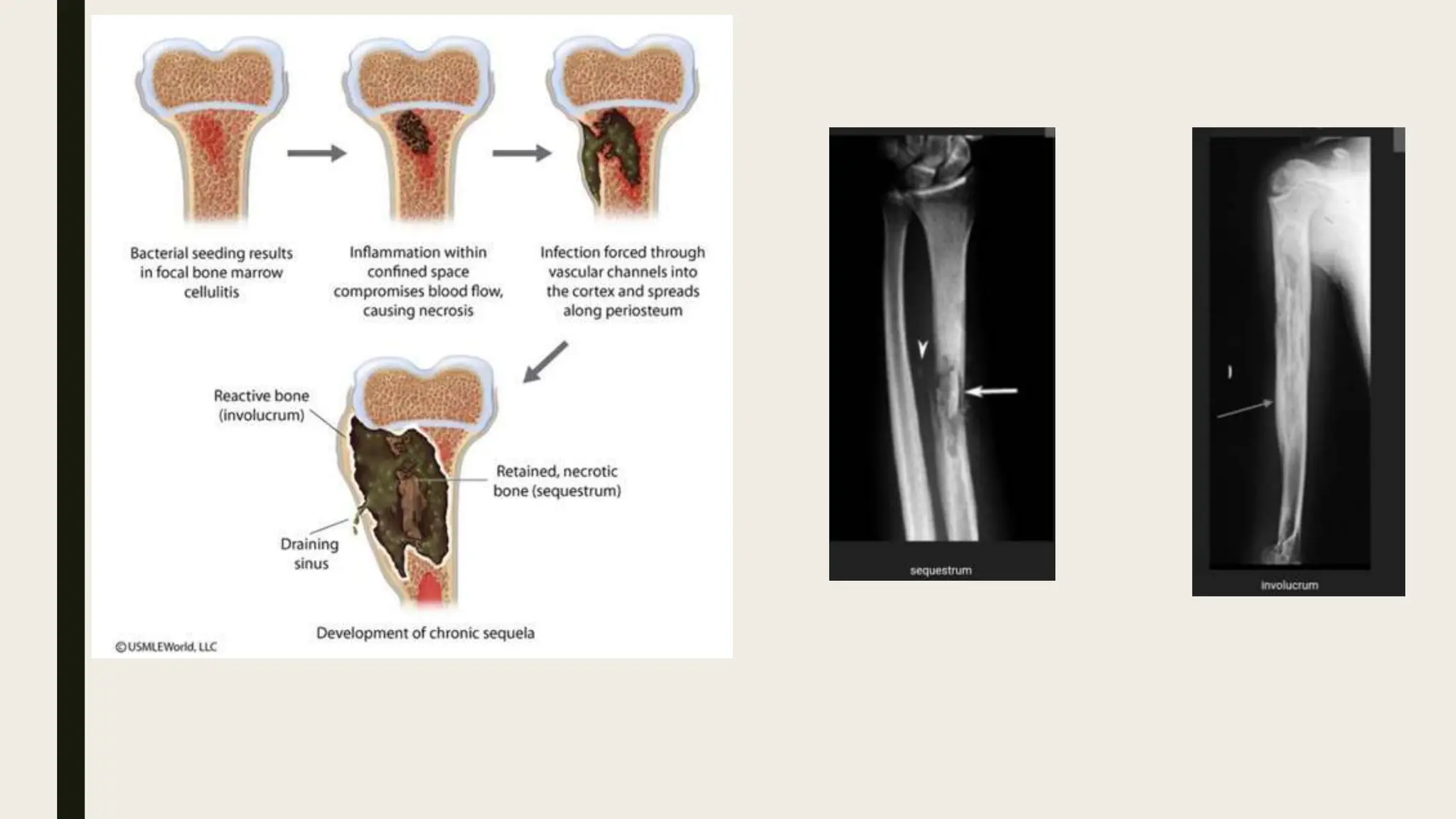 Osteomyelitis Ortho Slides Hospital.pptx