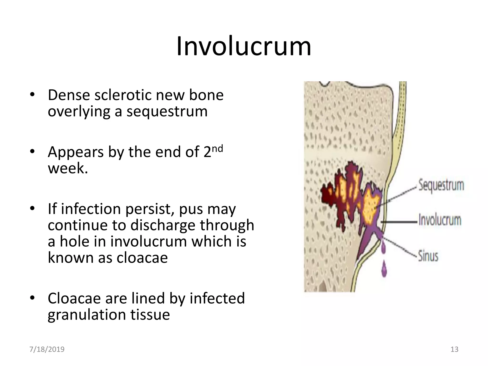 Osteomyelitis | PPTX