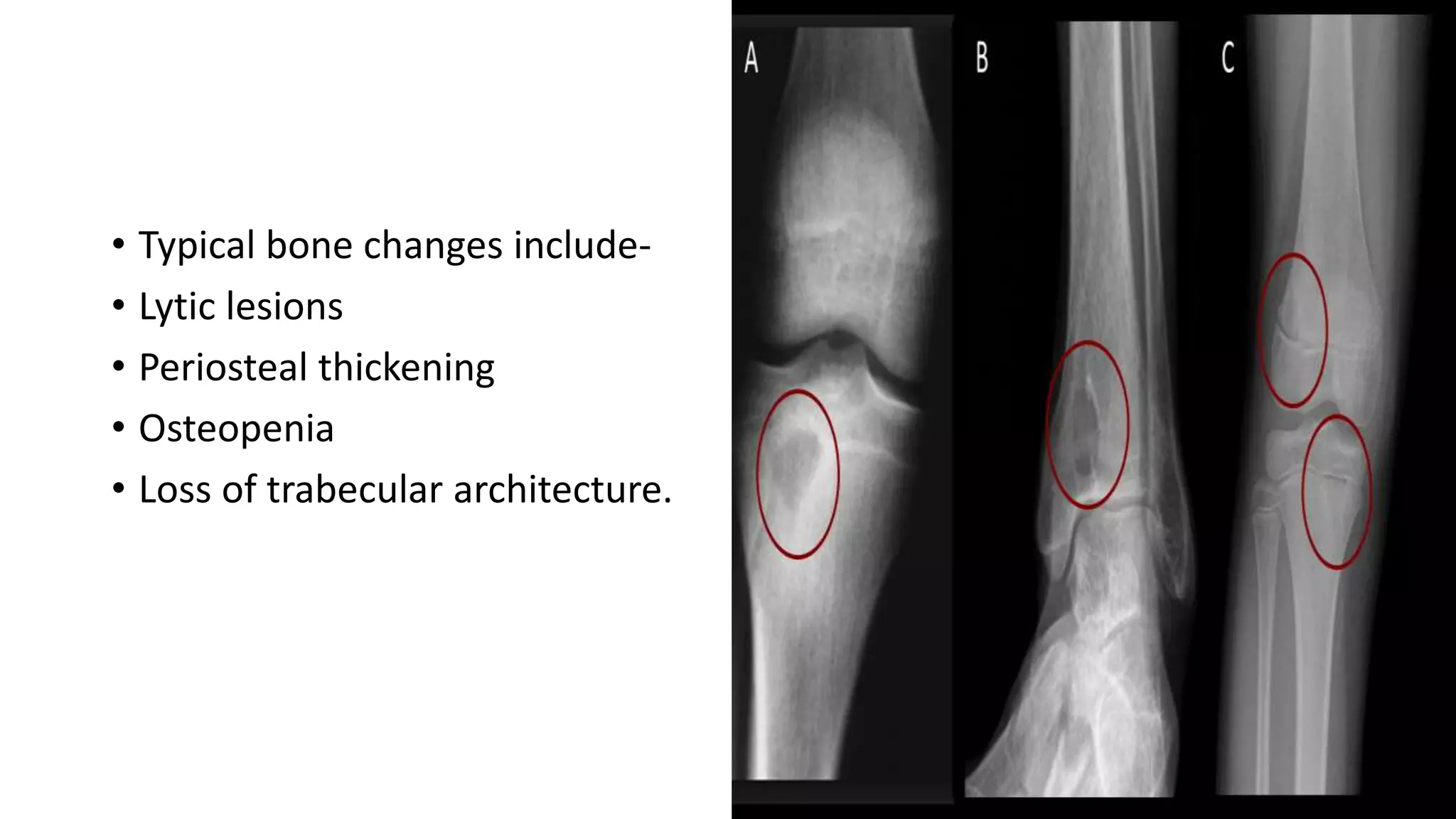 osteomyelitis ppt.pptx