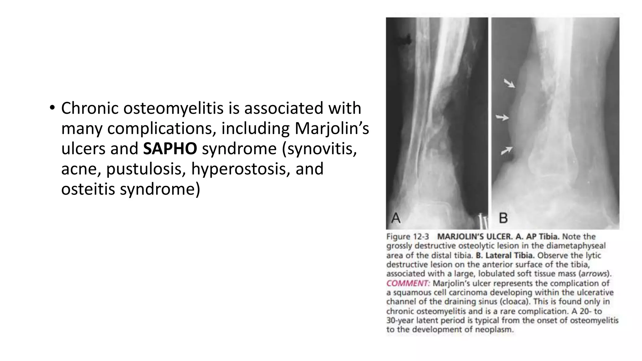 osteomyelitis ppt.pptx