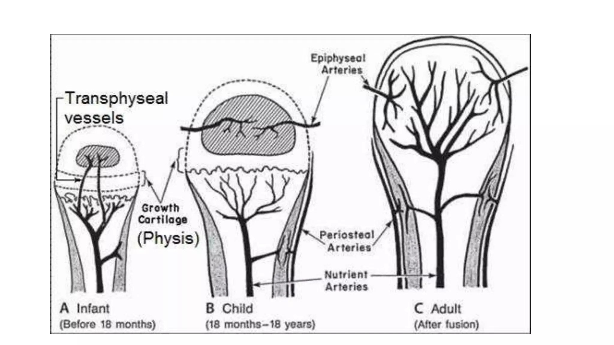 Osteomyelitis Pptpptx