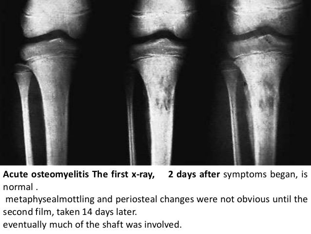 Osteomyelitis seminar