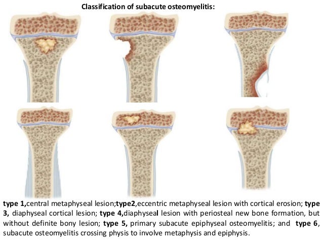 Osteomyelitis seminar