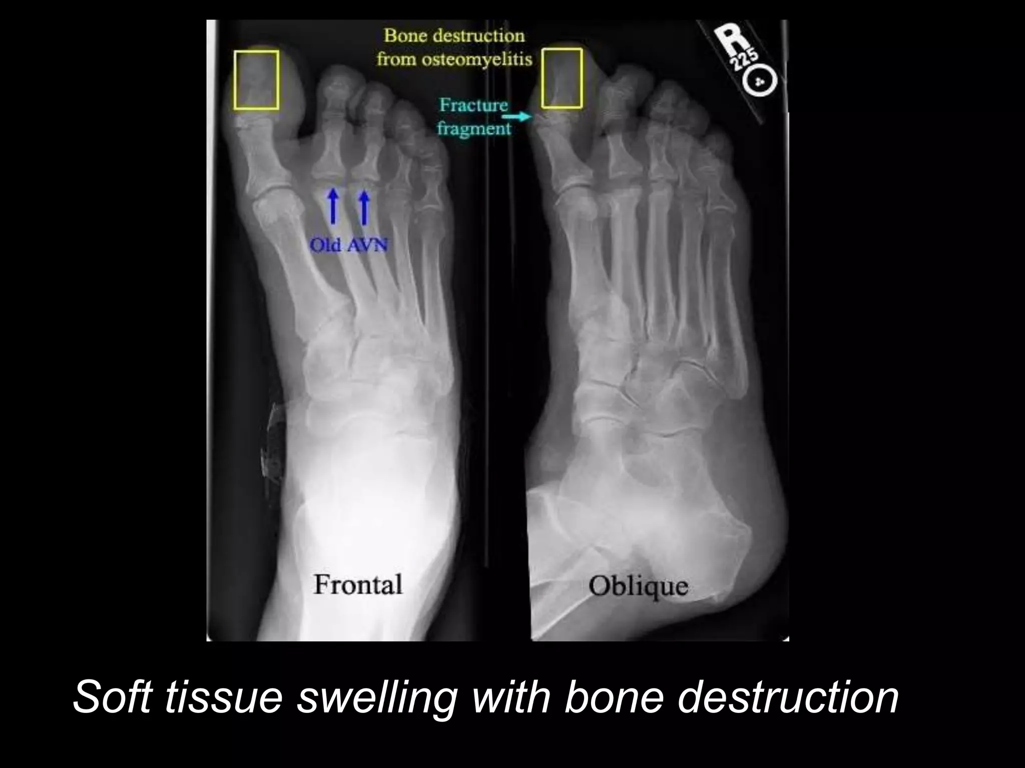Introduction to radiological diagnosis of osteomyelitis for ...