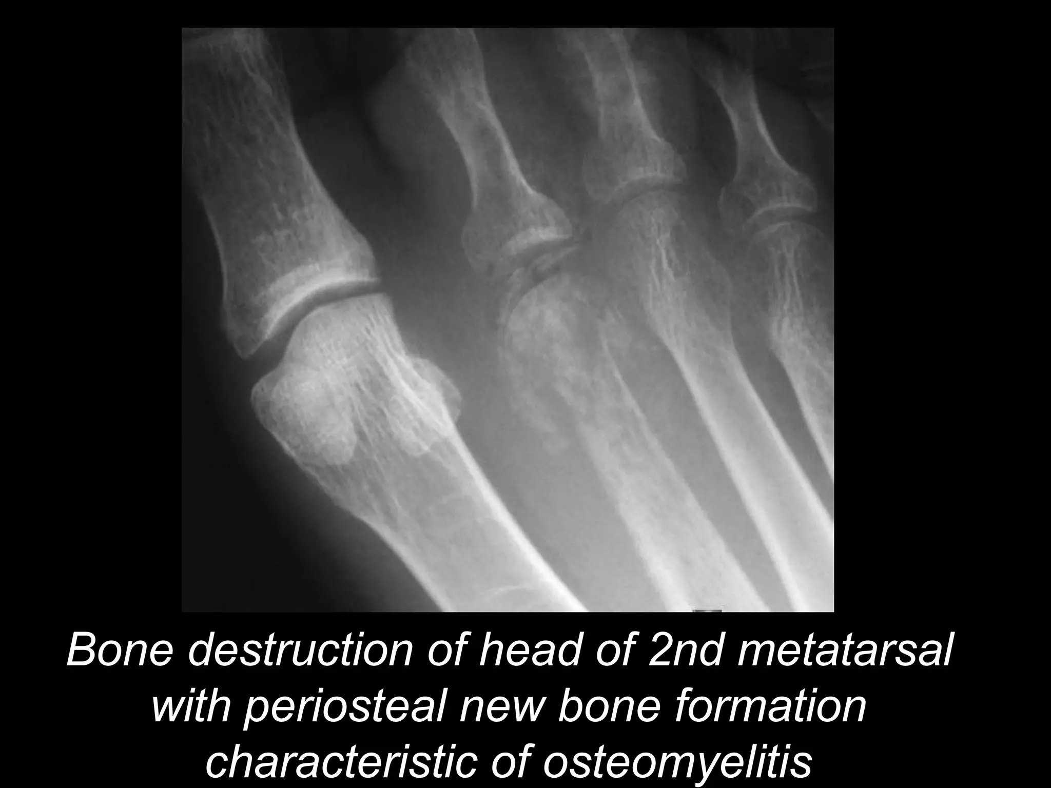 Introduction to radiological diagnosis of osteomyelitis for ...